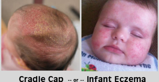 Eczema in Children – EczeMate